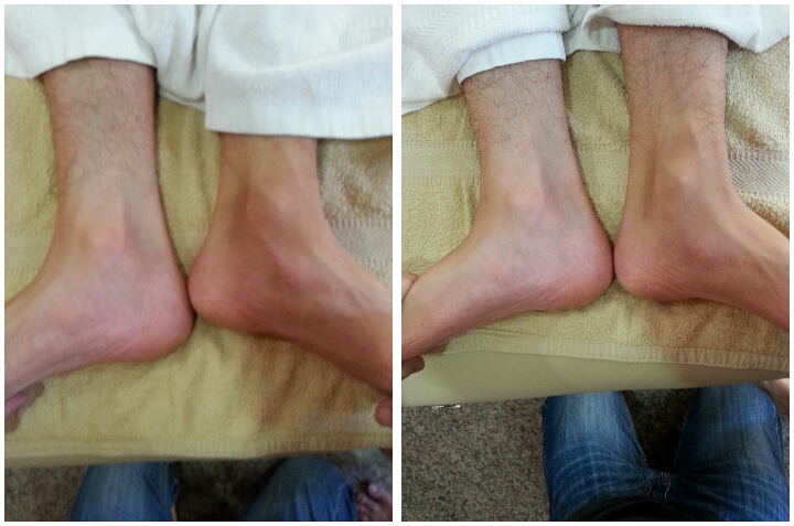 Short Leg Syndrome (Leg Length Discrepancy) | Wellness Care Health Services